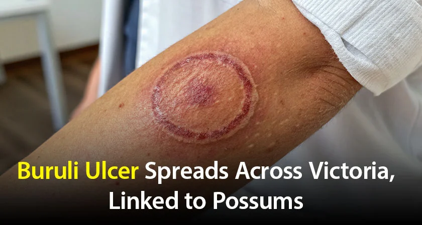 Buruli Ulcer Outbreak in Victoria: Possums Identified as Key Link